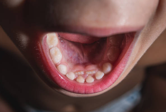 Shark Teeth in Kids: Is It Normal to Have Two Rows of Teeth?